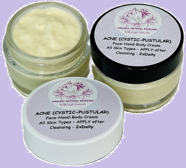 Acne (Cystic-Pustular) Face-Body Cream • Fempreneurs