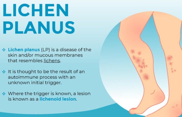 Lichen Planus Skin Cream • Fempreneurs